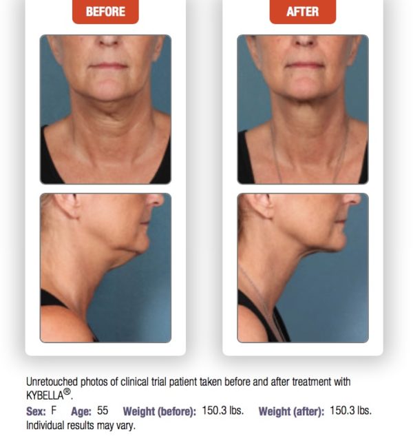 Kybella Treatments at Laser + Skin Institute | Chatam, New Jersey