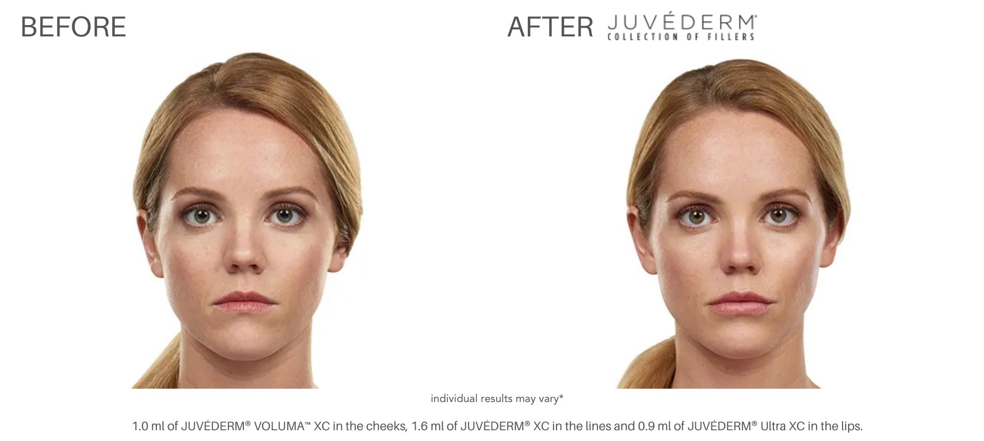 JUVÉDERM BEFORE AND AFTER | REAL PATIENT RESULTS