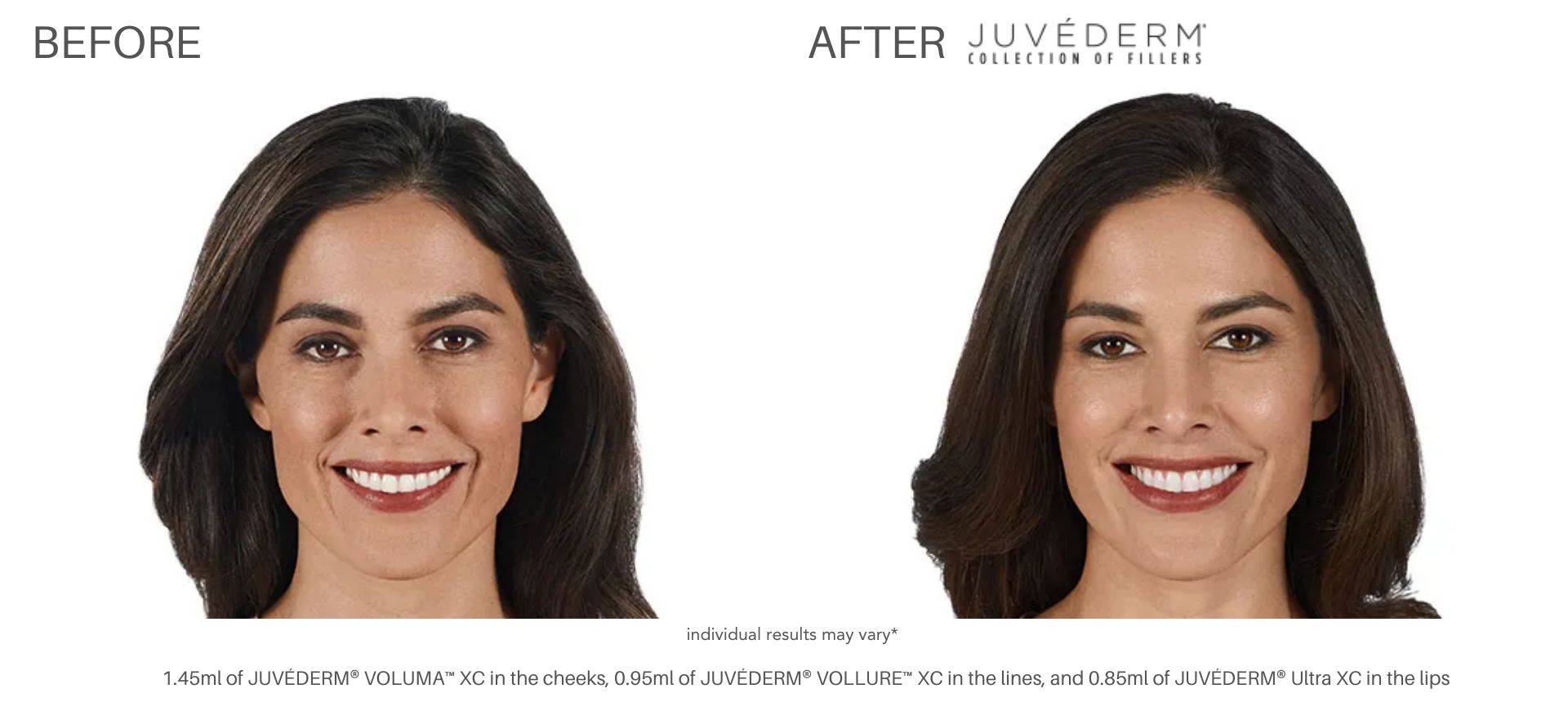 JUVÉDERM BEFORE AND AFTER | REAL PATIENT RESULTS