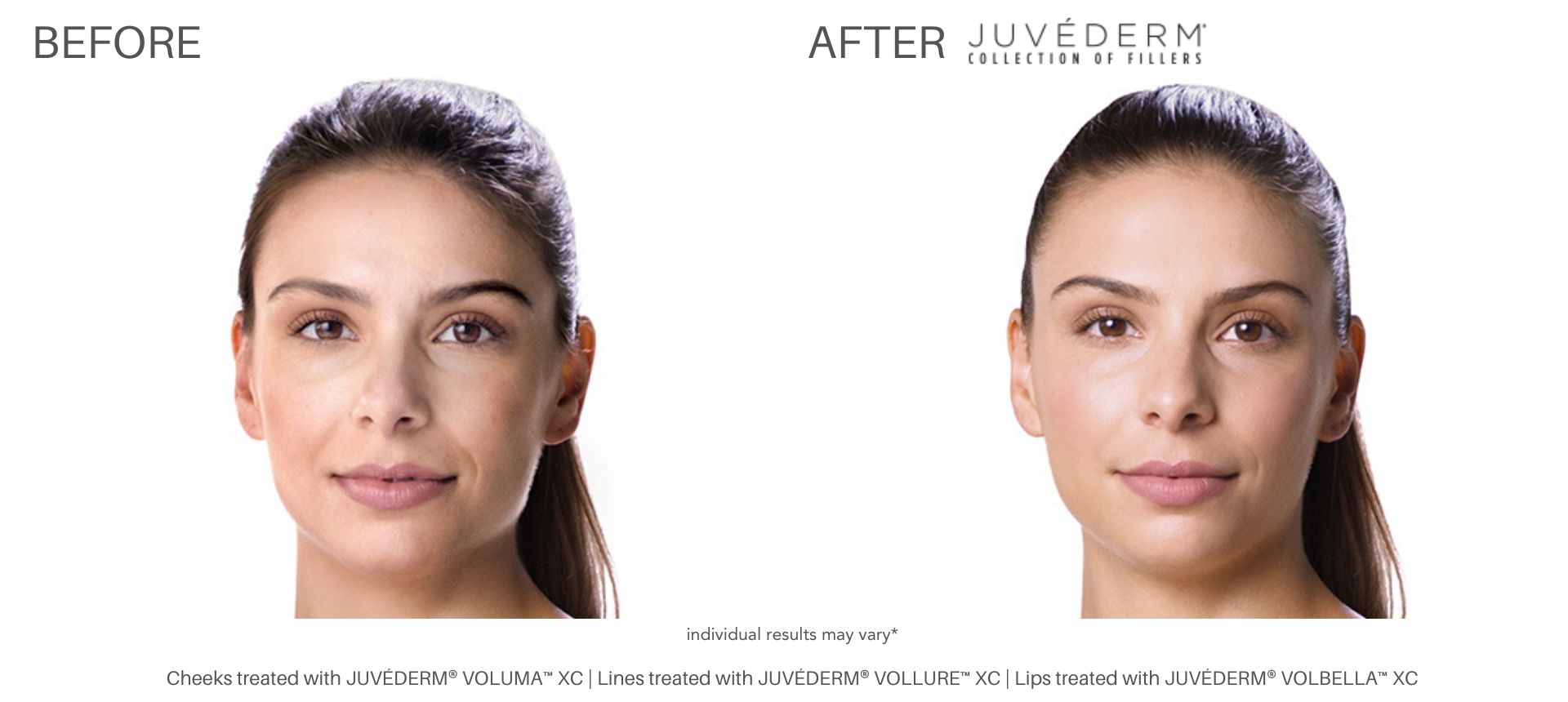 Juvederm Fillers at Laser + Skin Institute | Chatam, New Jersey