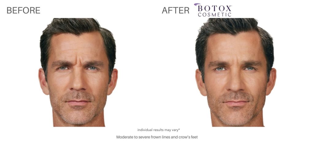 Botox Cosmetic at Laser + Skin Institute | Chatam, New Jersey