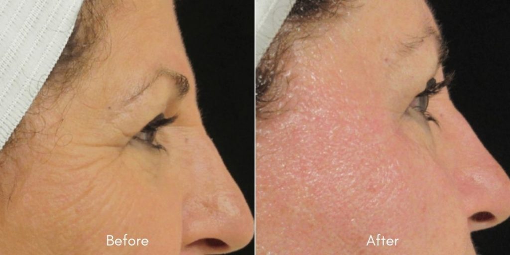 RF Skin Tightening | Improve Skin Laxity in Chatham