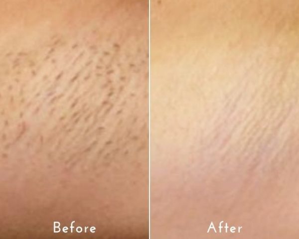 Laser Hair Removal At Laser Skin Institute Im Chatam Nj